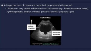 Approach and management of pediatric hydronephrosis | Epomedicine