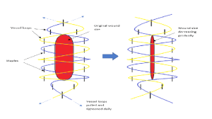 Shoelace technique for Delayed Primary Closure | Epomedicine