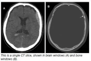 Interpretation of NCCT head: Normal findings | Epomedicine