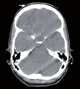 Interpretation of NCCT head: Normal findings | Epomedicine