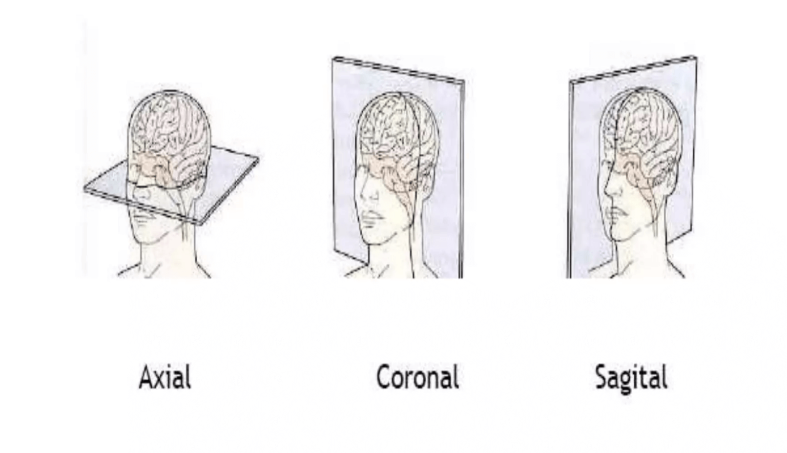 Interpretation of NCCT head: Normal findings | Epomedicine