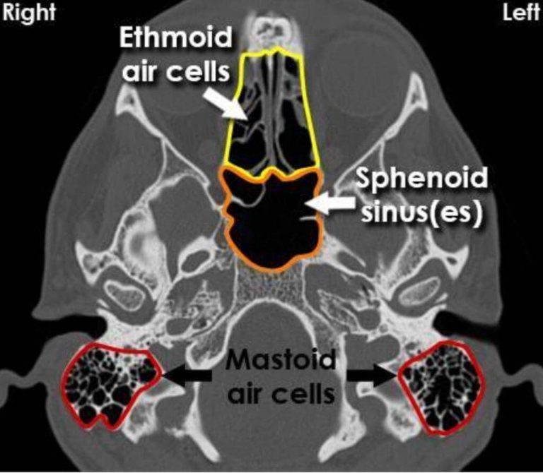 Interpretation of NCCT head: Normal findings | Epomedicine