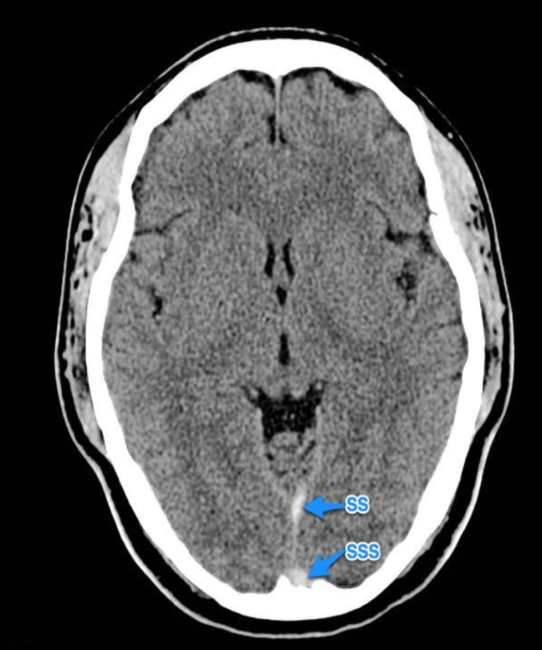 Interpretation of NCCT head: Normal findings | Epomedicine