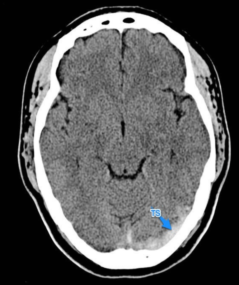 Interpretation of NCCT head: Normal findings | Epomedicine