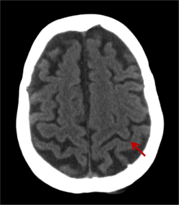 Interpretation of NCCT head: Normal findings | Epomedicine
