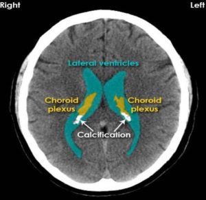 Interpretation of NCCT head: Normal findings | Epomedicine