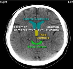 Interpretation of NCCT head: Normal findings | Epomedicine