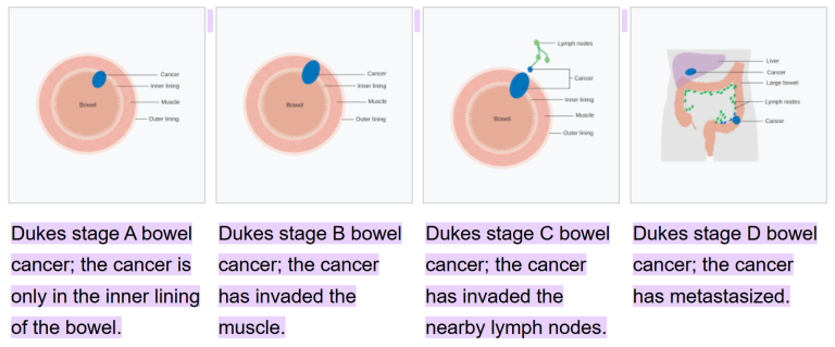 Colorectal carcinoma - Duke Staging and Management | Epomedicine