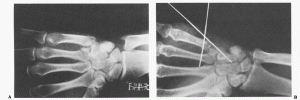 Reverse or Baby or Mirrored Bennett’s Fracture | Epomedicine