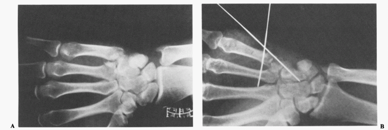 Reverse or Baby or Mirrored Bennett’s Fracture | Epomedicine