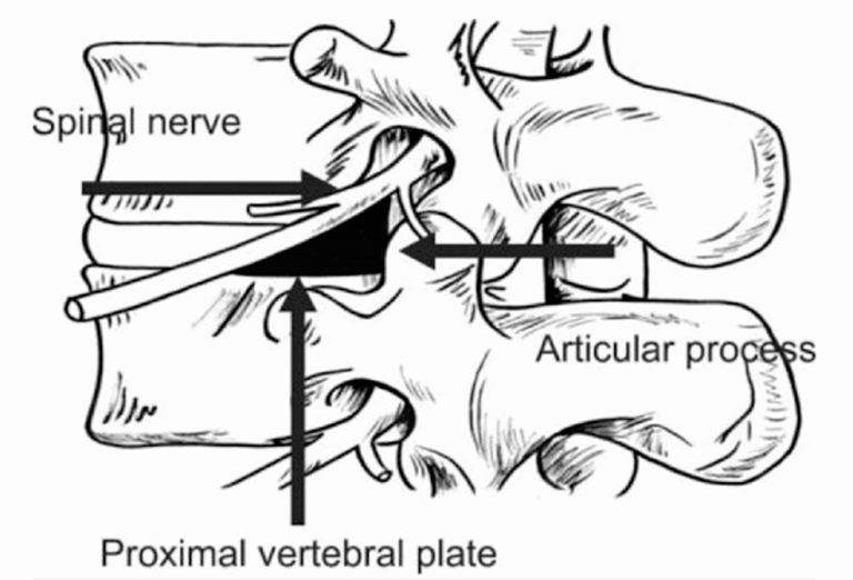 Kambin’s Triangle or Prism | Epomedicine