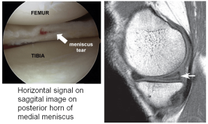 Meniscal Tears on MRI | Epomedicine