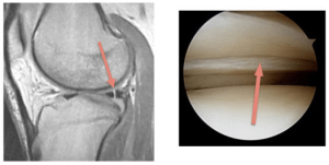 Meniscal Tears on MRI | Epomedicine