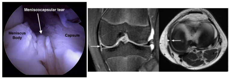 Meniscal Tears on MRI | Epomedicine