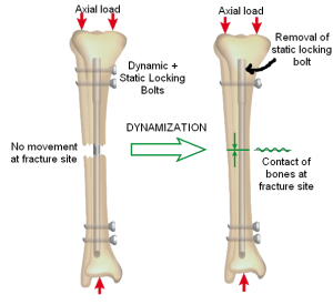 Intramedullary Nail Dynamization | Epomedicine