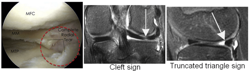 Meniscal Tears on MRI | Epomedicine