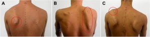 Scapular Dyskinesis | Epomedicine