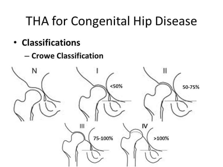 Crowe Classification in Adult Hip Dysplasia | Epomedicine