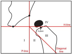 Tonnis and IHDI (International Hip Dysplasia Institute) Classification ...