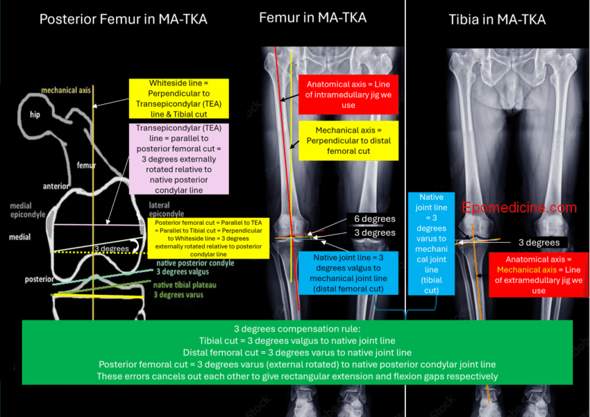 Mathematical Principles in Mechanically Aligned Total Knee Arthroplasty ...